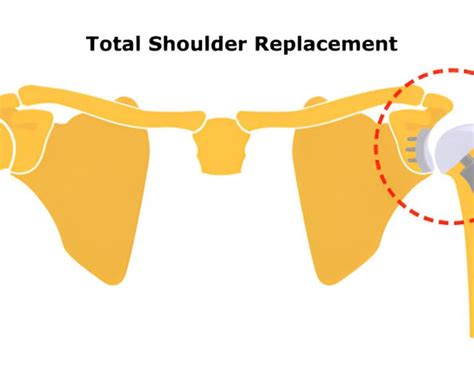 Shoulder Replacement Best Sports Injury And Joints Surgeon In Dehradun