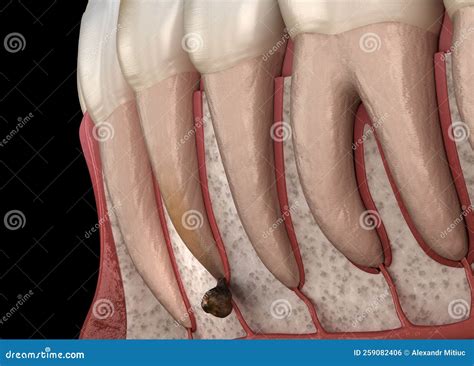 Periostitis Tooth Lump On Gum Above Tooth Medically Accurate Dental