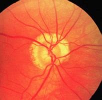 Retinal Abnormalities Gp Eyes