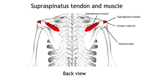 Supraspinatus Tendon Tear Causes Symptoms Diagnosis And Treatment