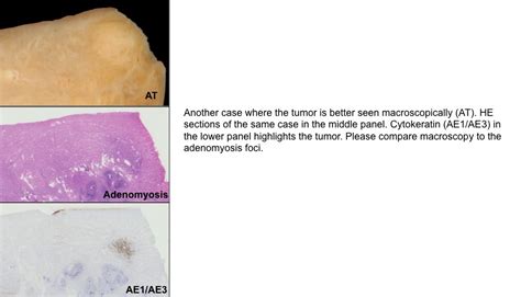 Gold Stage Copd Classification