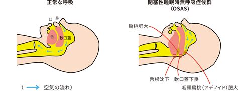 睡眠時無呼吸症候群 Online Mewsonline Mews