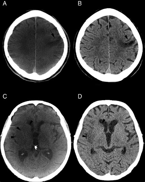 A An Older Small Cortical Infarction Is Depicted On The Flat Detector