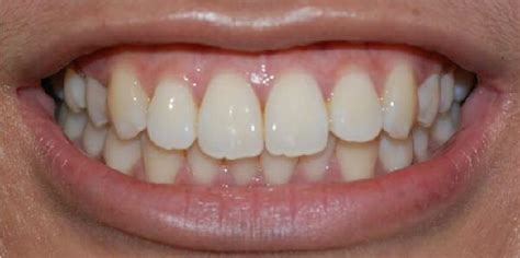 Photograph Of Smile Characteristics Close To Standard Norms Download