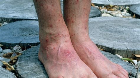 What Are Sand Fleas Moxie Pest Control