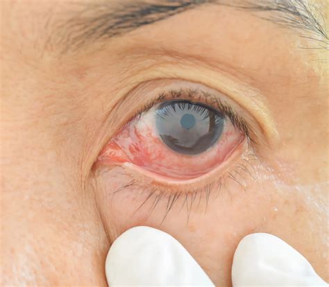 Bogotá Láser Guía Esencial Para Detectar Y Tratar La Queratitis A Tiempo