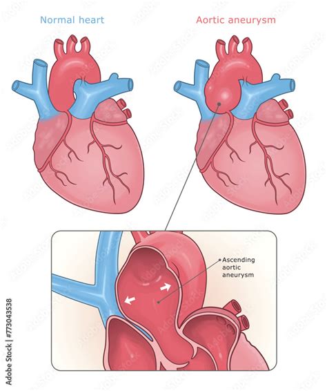 Normal Heart And Heart With Ascending Aortic Aneurysm Vector Medical