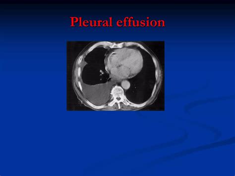 12 Pleural Effusionppt