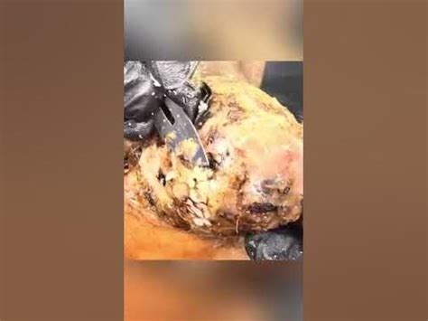 Satisfying Videos Jiggers Removal And Cleaning Jiggers Digging Youtube