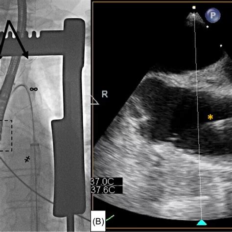 The Intraclude Device Is Positioned Under Fluoroscopic A And Tee B