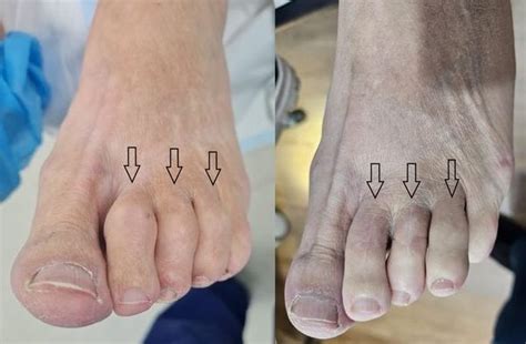 Rigid Hammertoe Deformity 2nd And 3rd Toes Flexible Hammertoe Deformity 4th Toe Pipj