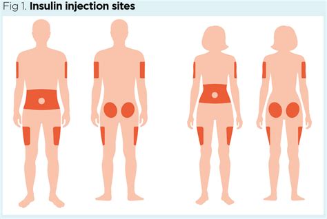 Type 1 Diabetes Treatment Management And The Use Of Insulin Nursing