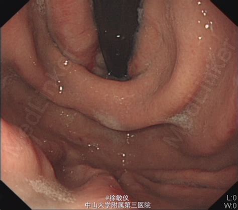 分享1例乙肝肝硬化失代偿病例。 医联