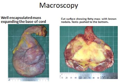 Paratesticular Liposarcoma A Rare Cause Of Scrotal Lump Pmc