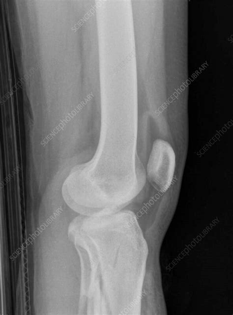 Lipohemarthrosis X Ray Stock Image F0365311 Science Photo Library