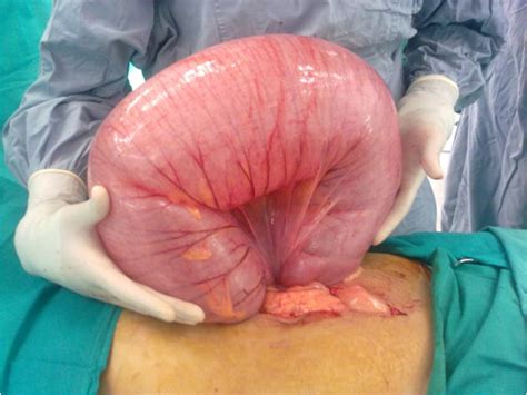 Operative Findings Showing Large Sigmoid Volvulus Download