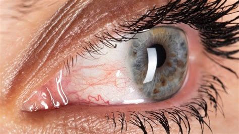 What Causes Eyelid Warts Safe Treatment Options Explained