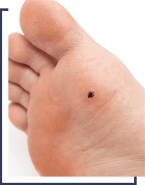 Planters Wart White At Carol Anderson Blog