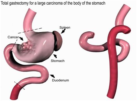 Total Gastrectomy