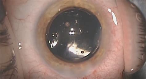 Black Addon Iol Eyetube