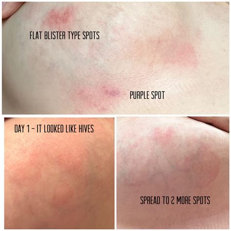 Keep Getting Sore Red Spots While Breastfeeding Thought It Was A Clog