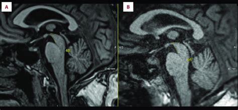 Sagittal Isotropic 3d T1 Magnetization Prepared Rapid Gradient Echo Download Scientific Diagram