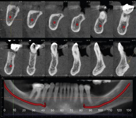 💀 Degenerative Joint Disease November 02 2022 Dental Scan Ltd