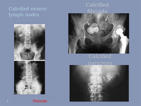 Ppt Radiology Of The Abdomen Powerpoint Presentation Free Download