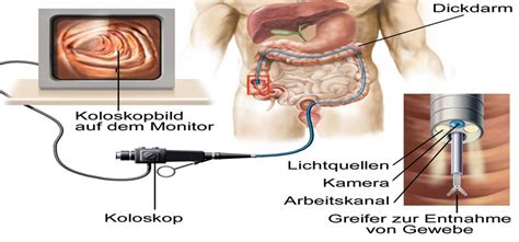 Diagnostic Sigmoidoscopy Ketaki Gastro Liver Clinic