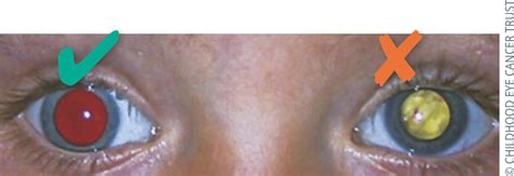 What Is The Red Reflex Test