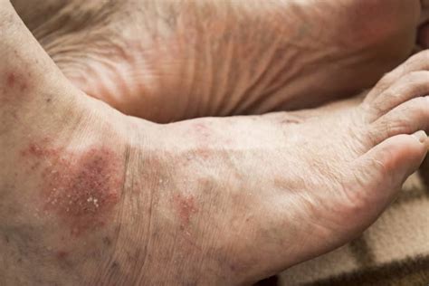 Contact Dermatitis And Your Feet The What Why And How Of Skin Reactions Feet First
