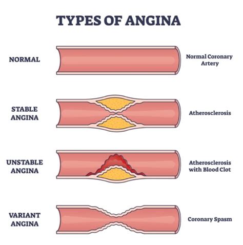 Angina Is A Warning Sign Learn How To Read It