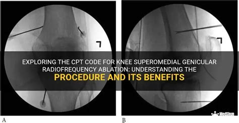 Exploring The Cpt Code For Knee Superomedial Genicular Radiofrequency Ablation Understanding