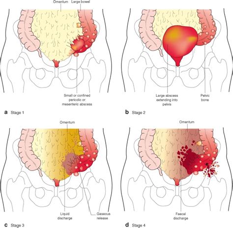 Classification De Hinchey Pour La Diverticulite Aiguë Guide Du