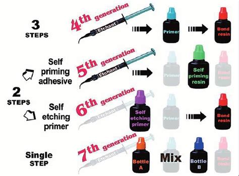 Generations Of Composite Bonding Agents Medizzy