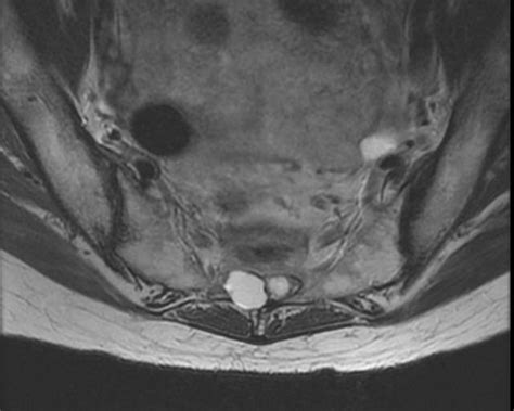 Radiopaedia Case Sacral Meningeal Cyst Id 11900 Study 12263 Nc Commons