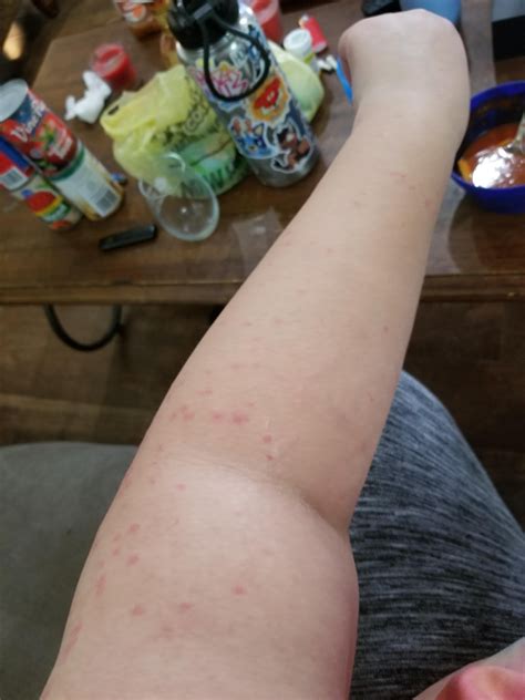 Red Dots All Over Arms And Legs Rdermatologyquestions