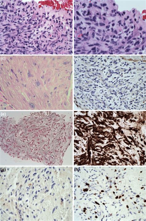 Pathology Slides Fibrosarcoma A Spindled Pleomorphic Cells Of