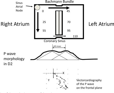 Ectopic Atrial Pacemaker Semantic Scholar