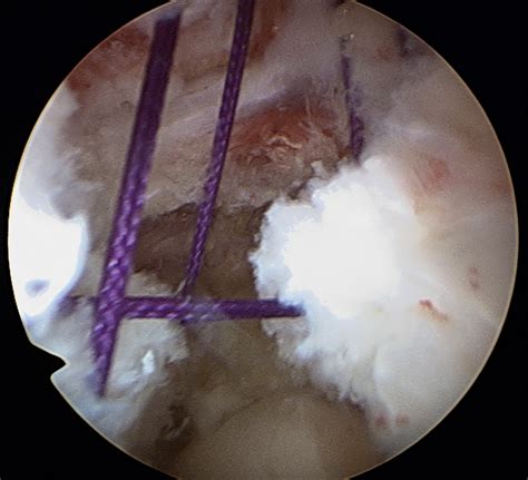 Capsular Plication Hip דר איתמר בוצר