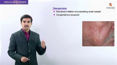 Vascular Ectasias Nevus Flammeus Port Wine Stain Salmon Patch Telangiectasias Youtube
