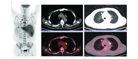 Multiple Hypermetabolic Nodular Lesions In The Anterior Segment Of Download Scientific