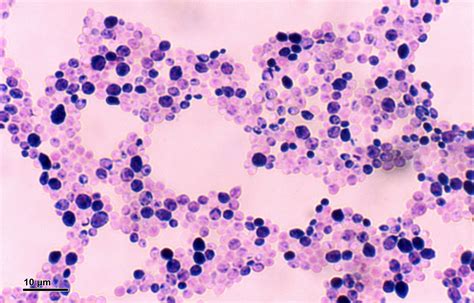 Candida Albicans Définition La Candidose Définition Et Symptômes