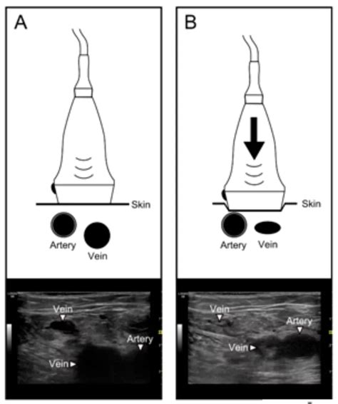 Dvt Archives Page 2 Of 5 Usabcd
