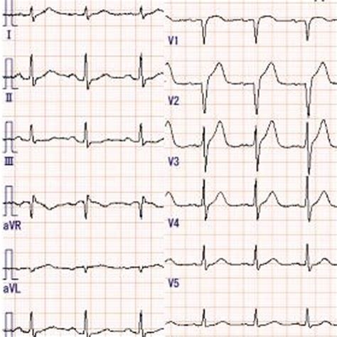 Treatment Strategies For Patients With Ccb Associated Peripheral Edema