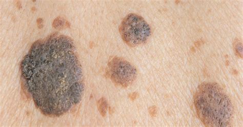 What Is Seborrheic Keratosis