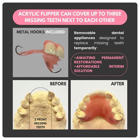 Acrylic Flipper For Up To 3 Teeth Dental Solution Smile Boutique Ny
