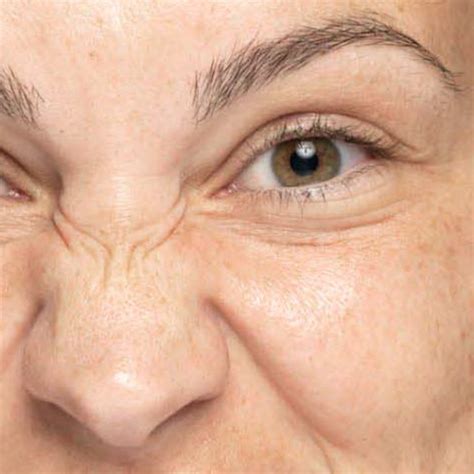 Fine Lines And Wrinkle Treatment Victorian Dermal Group