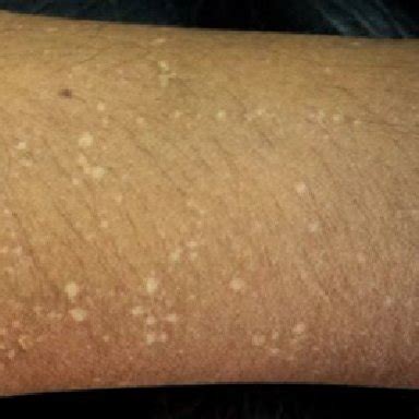 Lesions Of Idiopathic Guttate Hypomelanosis And Extragenital Lichen