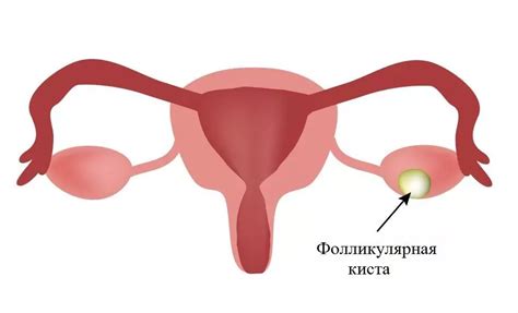 Follicular Ovarian Cyst Symptoms Treatment Causes Diseases